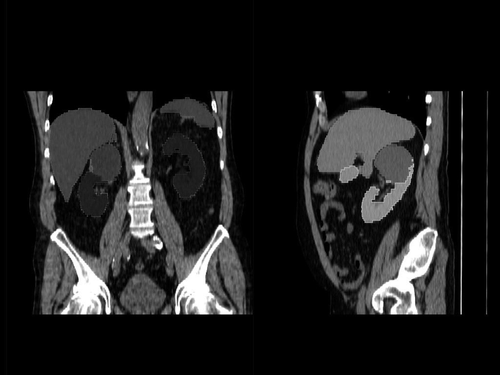 Abdomen Pelvis Ct Dataset Trainingdatapro